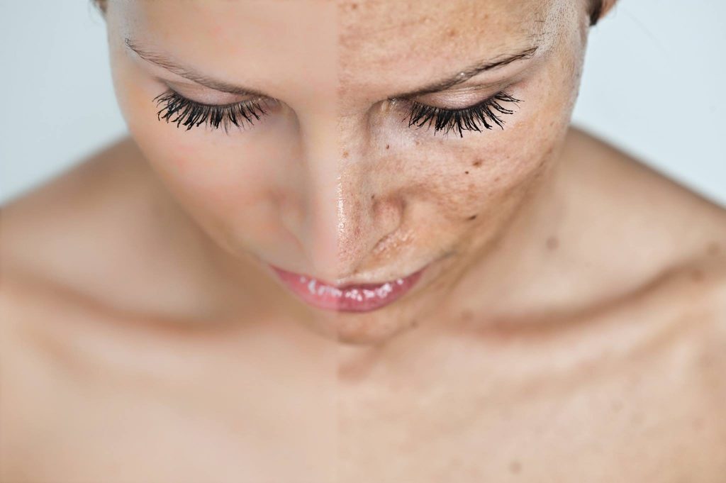 Scar Camouflage Permanent Makeup By Rosie Wells Scar Camouflage Permanent Makeup By Rosie Wells
